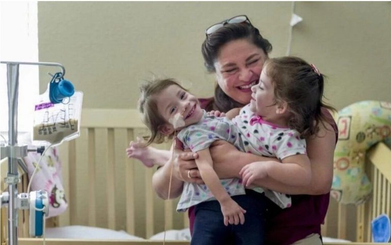 What do Siamese Twins, who were Able to be Separated a Few Years Ago ...