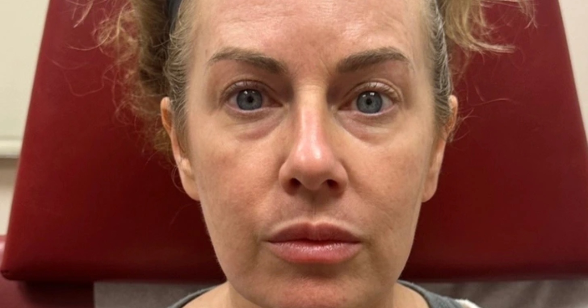 A Woman Dreamt Of Regaining Her Youthful Look: The Result Of The Botox ...